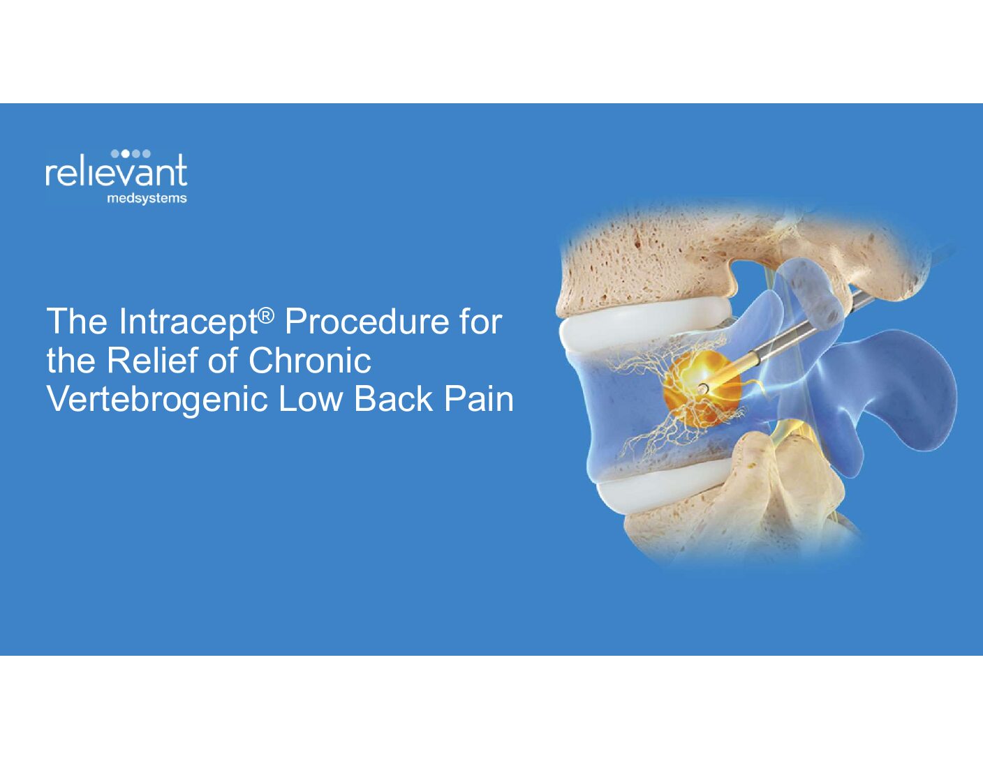 Intracept Procedure - Pain Specialists of Greater Chicago